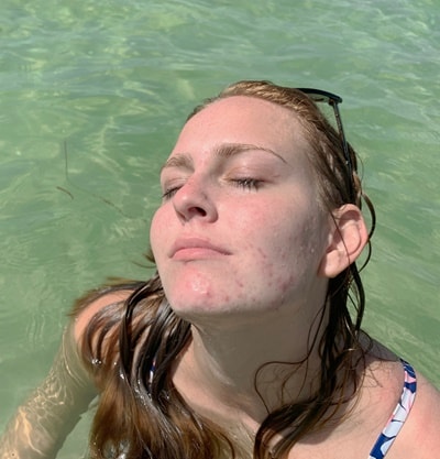 Acne solar: como cuidar da pele nessa temporada? | Garnier