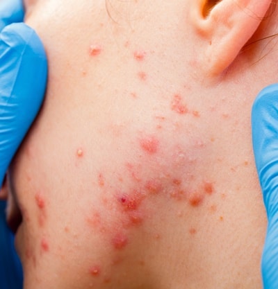 Acne grau 3: dermatologista explica os sintomas e como tratar.