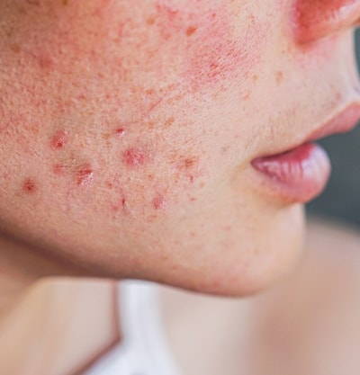 Acne: dermatologista explica o que é, tratamento e tipos