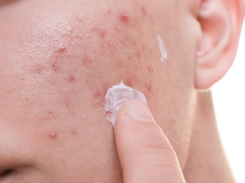 Acne: dermatologista explica o que é, tratamento e tipos Acne: dermatologista explica o que é, tratamento e tipos