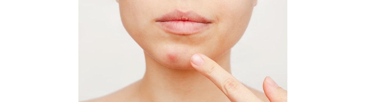 Espinha no queixo: entenda as causas e diga adeus a este incômodo