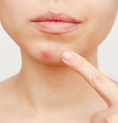 Espinha no queixo: entenda as causas e diga adeus a este incômodo