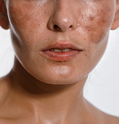 Melasma: dermatologista fala o que é, sinais e como tratar