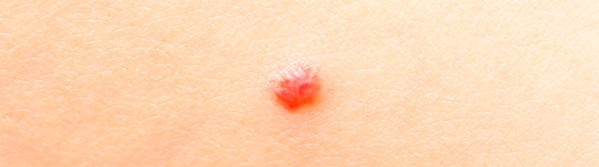 Pintas vermelhas na pele: o que são, como surgem e como tratar?