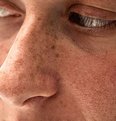 Manchas de sol no rosto: saiba como evitar e tratar