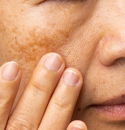 Manchas Solares na Pele: Causas, Prevenção e Tratamento