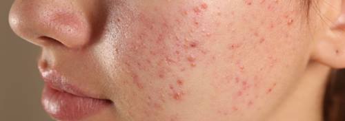 Ácido lático: o que é, benefícios e como usar na pele