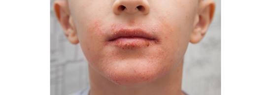 Lábios ressecados: causas e como prevenir o ressecamento labial