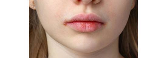 Lábios ressecados: causas e como prevenir o ressecamento labial