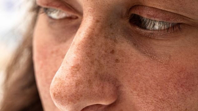 Melanose solar: o que é, como tratar e prevenir as manchas de sol