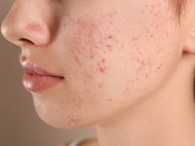 Acne: dermatologista explica o que é, tratamento e tipos