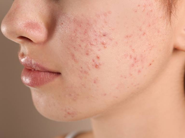 Acne: dermatologista explica o que é, tratamento e tipos