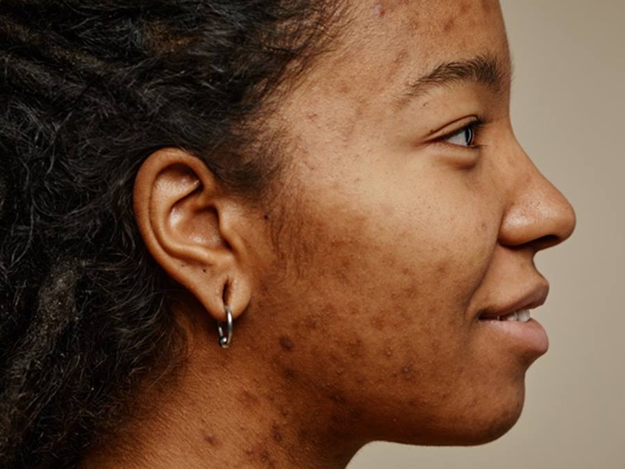Acne: dermatologista explica o que é, tratamento e tipos