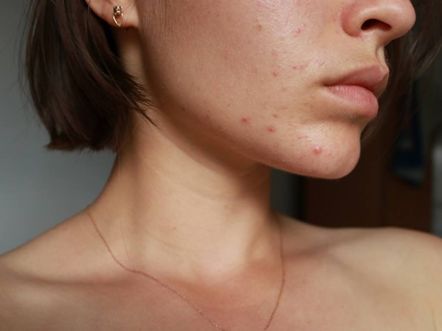 Acne: dermatologista explica o que é, tratamento e tipos