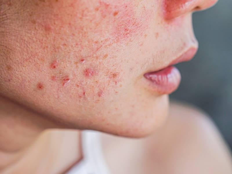 Acne: dermatologista explica o que é, tratamento e tipos