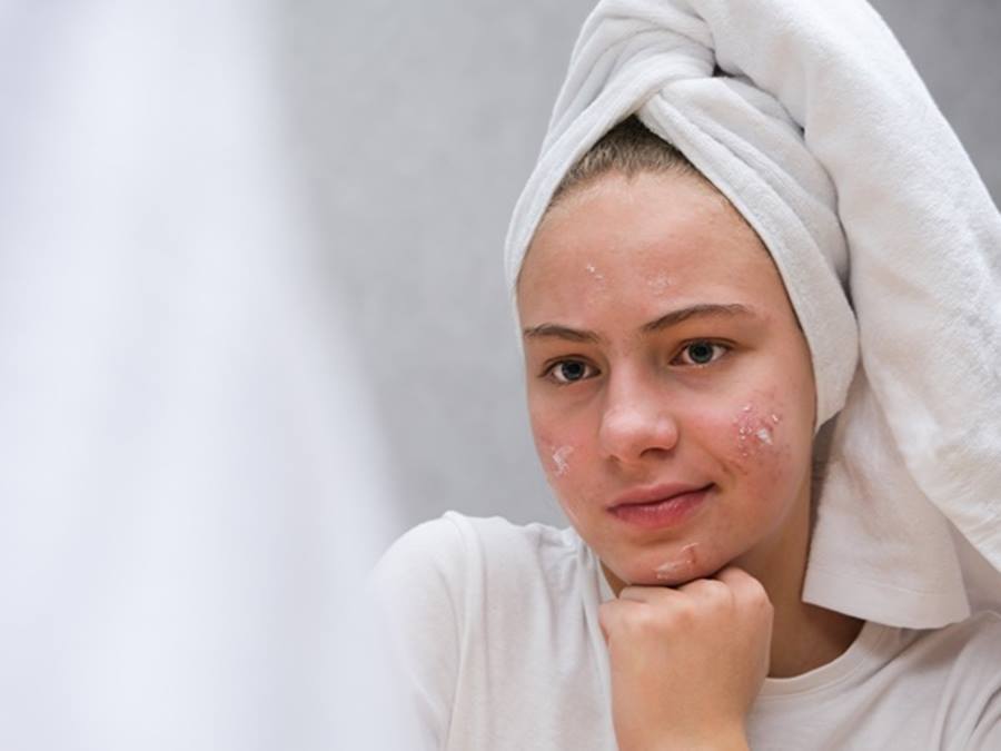 Acne: dermatologista explica o que é, tratamento e tipos