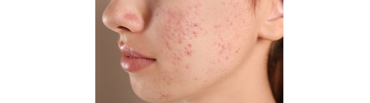 Como evitar espinhas? Conheça as causas e os tratamentos