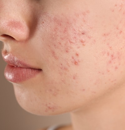 Como evitar espinhas? Conheça as causas e os tratamentos