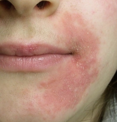 Entenda a dermatite e descubra como cuidar da sua pele