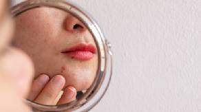 Espinha inflamada: dermatologista fala o que causa e como tratar?