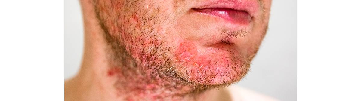 O que é foliculite? Entenda as causas e como tratar