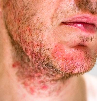 O que é foliculite? Entenda as causas e como tratar